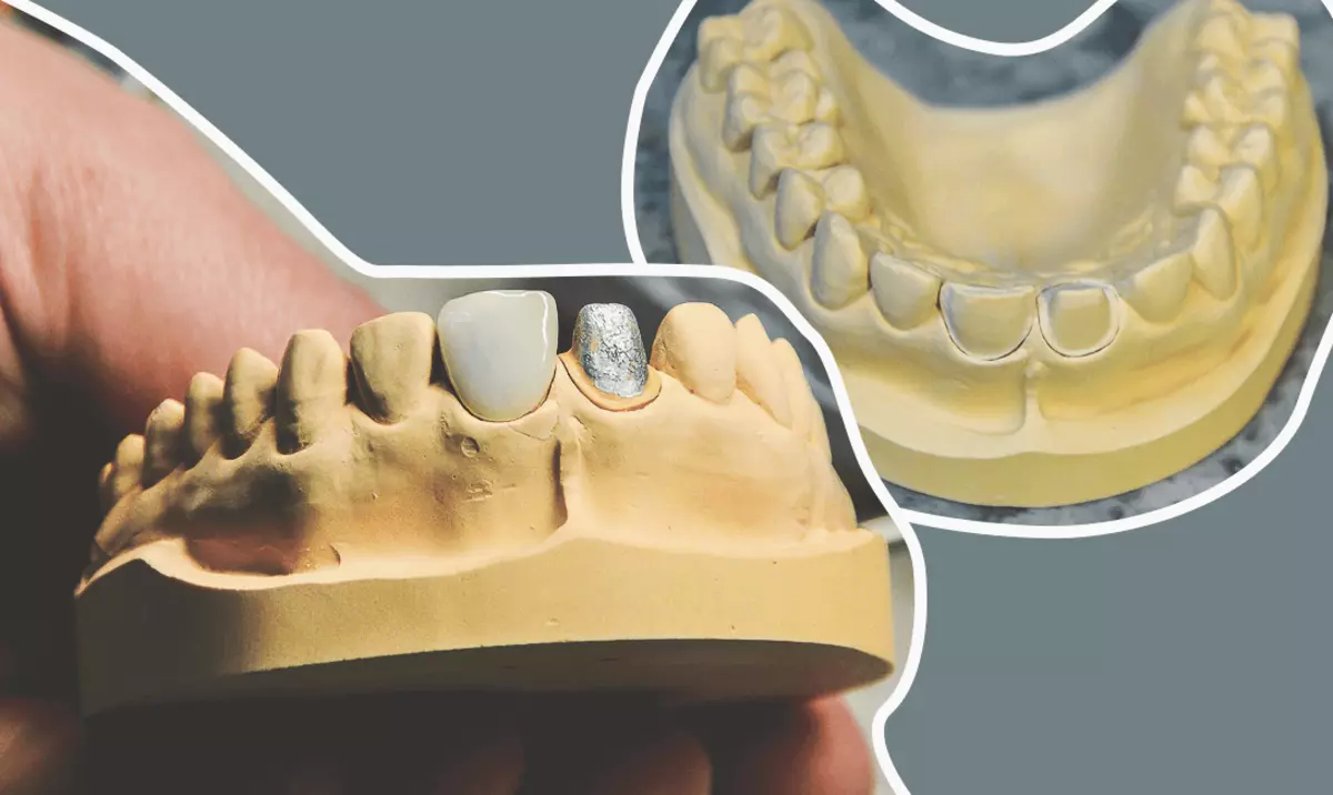 Hoe veneers u zullen helpen bij het bereiken van een ideale glimlach 10898_3