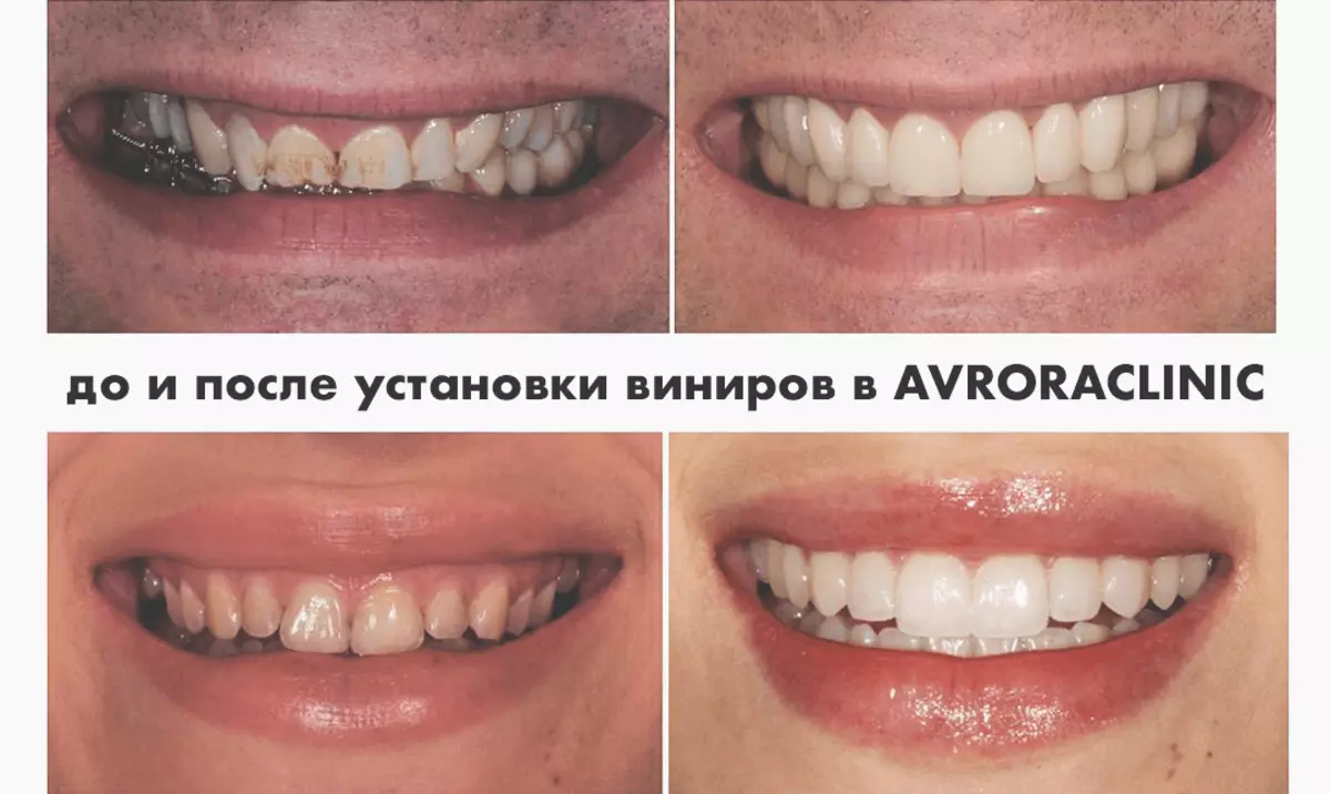 Si veneers do t'ju ndihmojnë të arrini një buzëqeshje ideale 10898_5